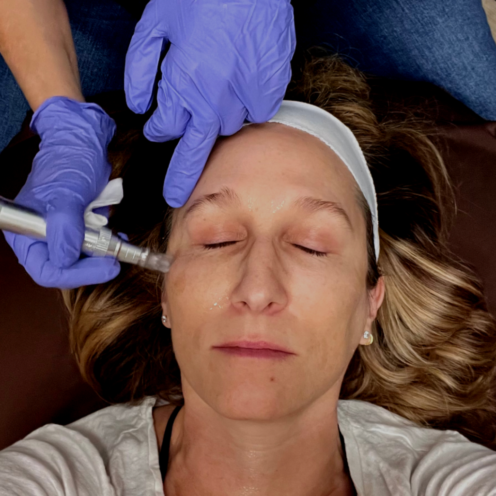 Microneedling: Collagen Induction Therapy - Valley Pointe Acupuncture